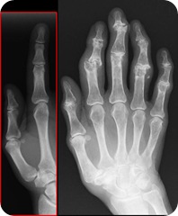 Skeletal disorders: Heberden's node